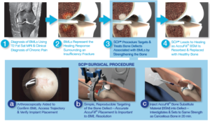 Subchondroplasty | Chronic Bone Marrow Lesions Treatment