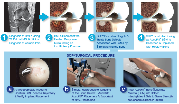Subchondroplasty | Chronic Bone Marrow Lesions Treatment